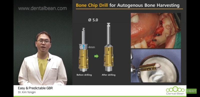 Save GBR kit by dentis - 김용진 원장님 : 네이버 블로그