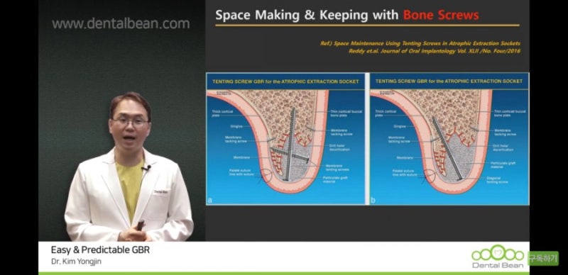 Save GBR kit by dentis - 김용진 원장님 : 네이버 블로그