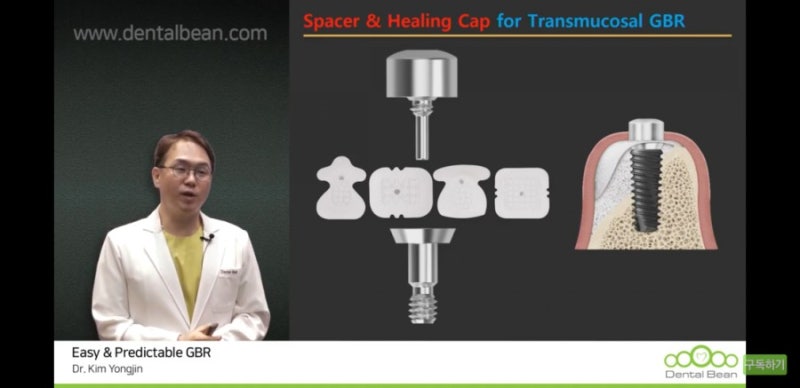 Save GBR kit by dentis - 김용진 원장님 : 네이버 블로그