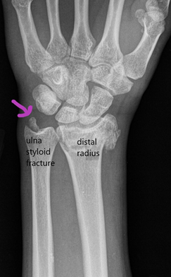 Wrist TFCC(Triangular fibrocartilage complex) injury - 손목 삼각섬유연골복합체 손상 ...