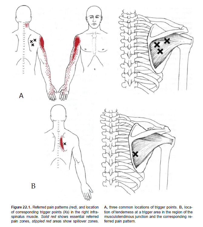 극하근 통증 유발점 (Infraspinatus Trigger Point) : 네이버 블로그
