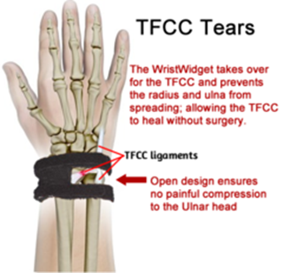 Wrist TFCC(Triangular fibrocartilage complex) injury - 손목 삼각섬유연골복합체 손상 ...
