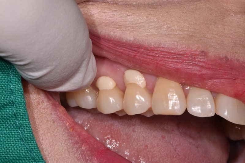 잇몸이 패였어요? 잇몸이 아니라 치아가 패인거에요 치경부 레진충전 치료 abfraction composite filling ...