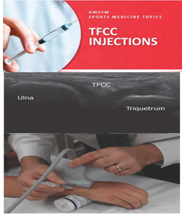 Wrist TFCC(Triangular fibrocartilage complex) injury - 손목 삼각섬유연골복합체 손상 ...