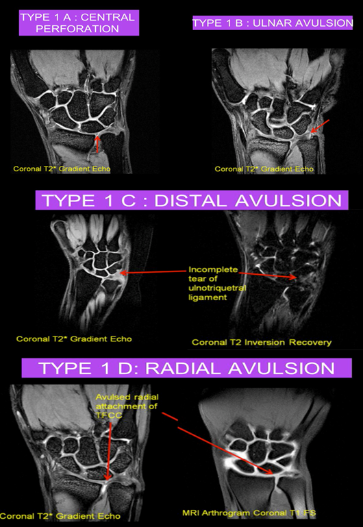 Wrist TFCC(Triangular fibrocartilage complex) injury - 손목 삼각섬유연골복합체 손상 ...