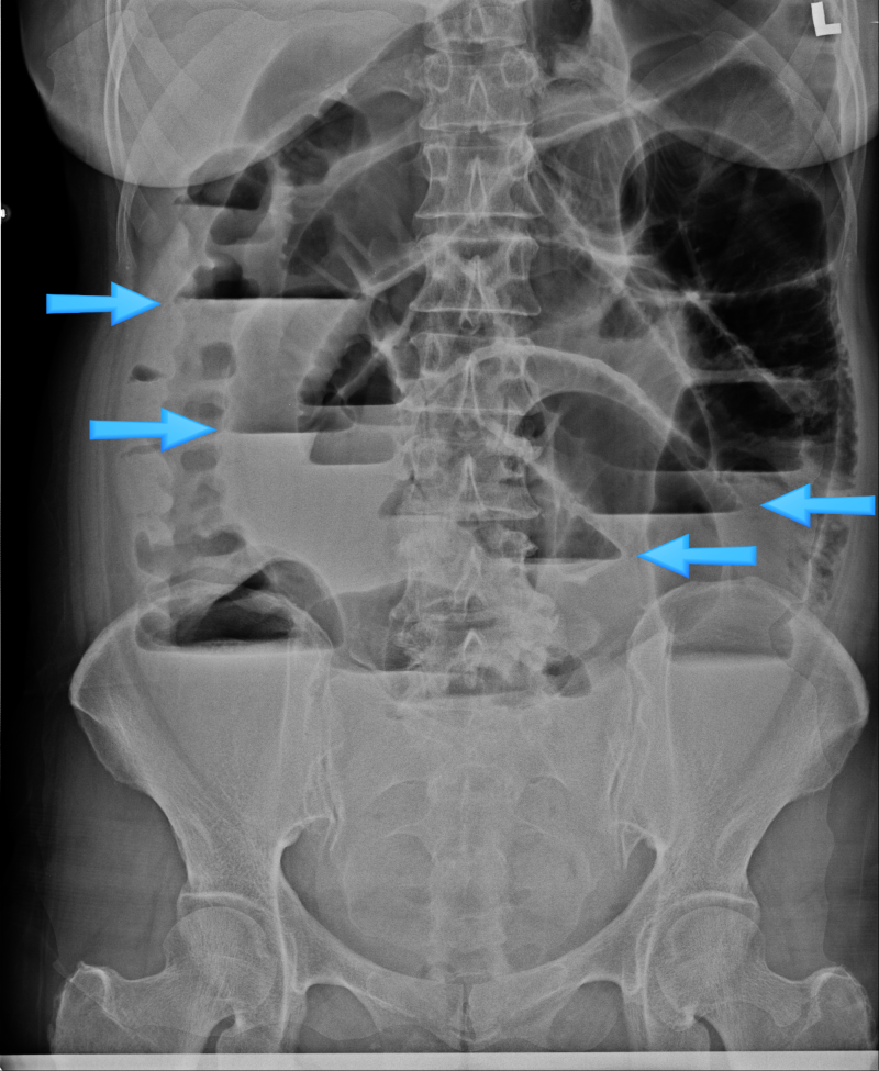 장폐색(bowel obstruction)이 있는 대장암의 수술적 치료는? : 네이버 블로그