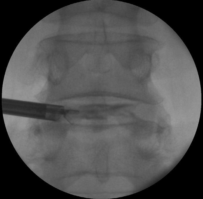 극심한 허리디스크 통증 척추내시경 시술(PELD)로 잡자! : 네이버 블로그