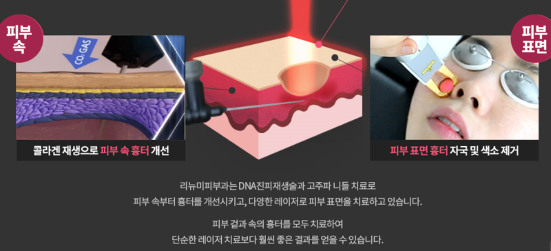 얼굴 흉터 제거 봉합 수술 상처 치료 사고 흉터 붉은흉터 패인흉터 외상흉터 흉터제거 열상흉터 치료 전문 눈썹