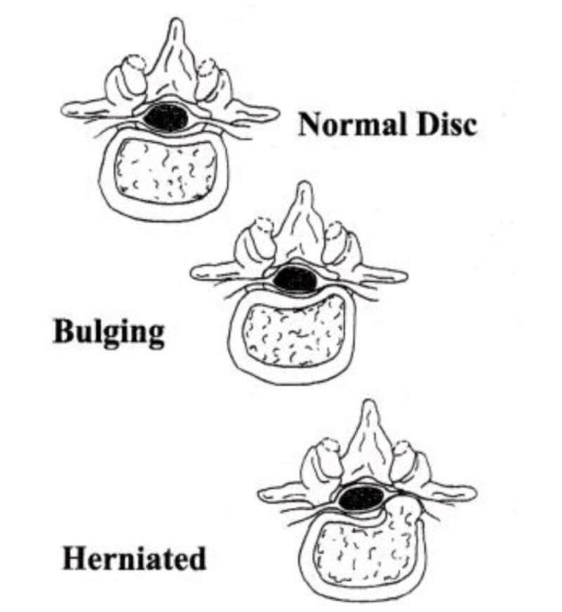 허리디스크 (추간판 탈출증)/Herniated Nucleus Pulposus (HNP/HIVD(Herniated ...