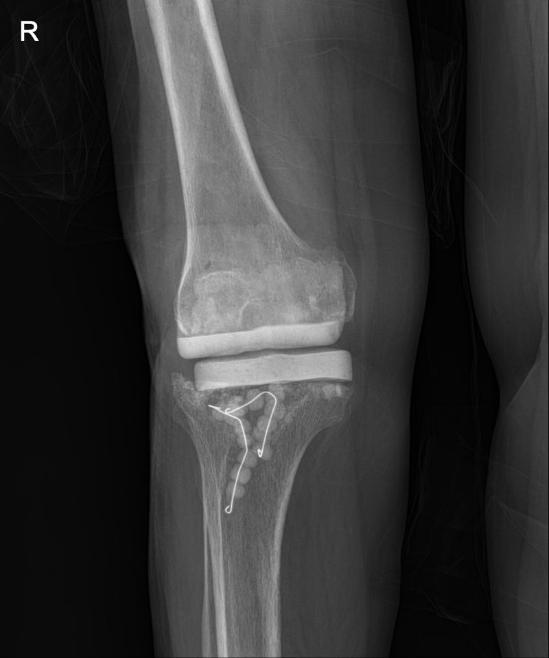 무릎 인공관절 수술 후 발생한 인공관절 감염에서 PROSTALAC 을 이용한 2단계 무릎 인공관절 재치환술 / 올바른서울병원 ...