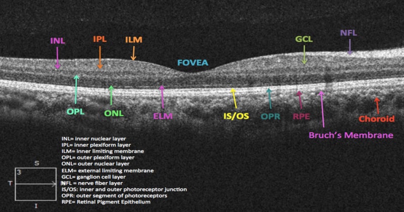 안구광학단층검사, 빛간섭단층촬영(Spectralis OCT) : 네이버 블로그