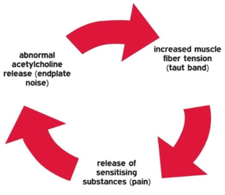 MPS : Myofascial Pain Syndrome & TrP: Trigger Point – 근막통증증후군과 트리거포인트 ...