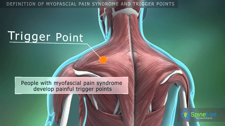MPS : Myofascial Pain Syndrome & TrP: Trigger Point – 근막통증증후군과 트리거포인트 ...