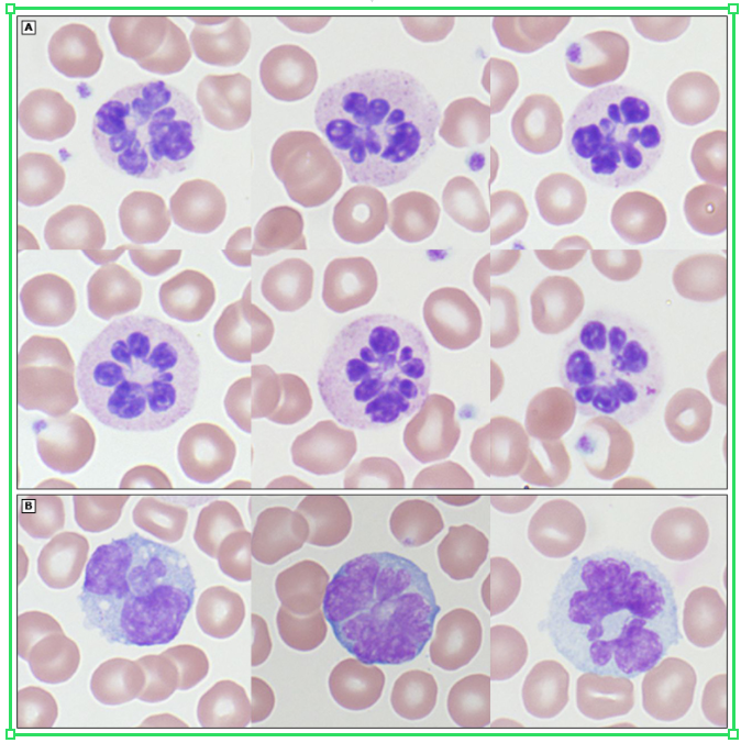 Lobulation of neutrophils, peripheral blood smear (ex,hypersegmentation ...