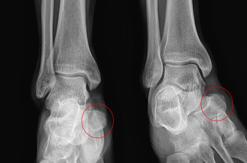 증상이 있는 부주상골(Accessory Navicular Bone) 치료 : 네이버 블로그