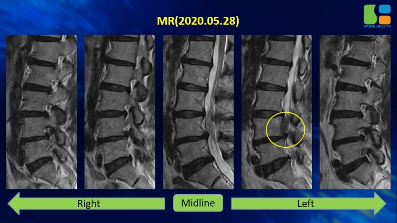 우리들병원 임상례 논문 - '접근이 어려운 요추간판 탈출증'의 척추체 뿌리뼈 관통을 통한 내시경 수술 / 4,5번 허리 디스크 ...