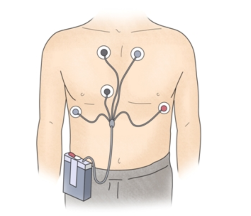 Holter monitoring : 네이버 블로그
