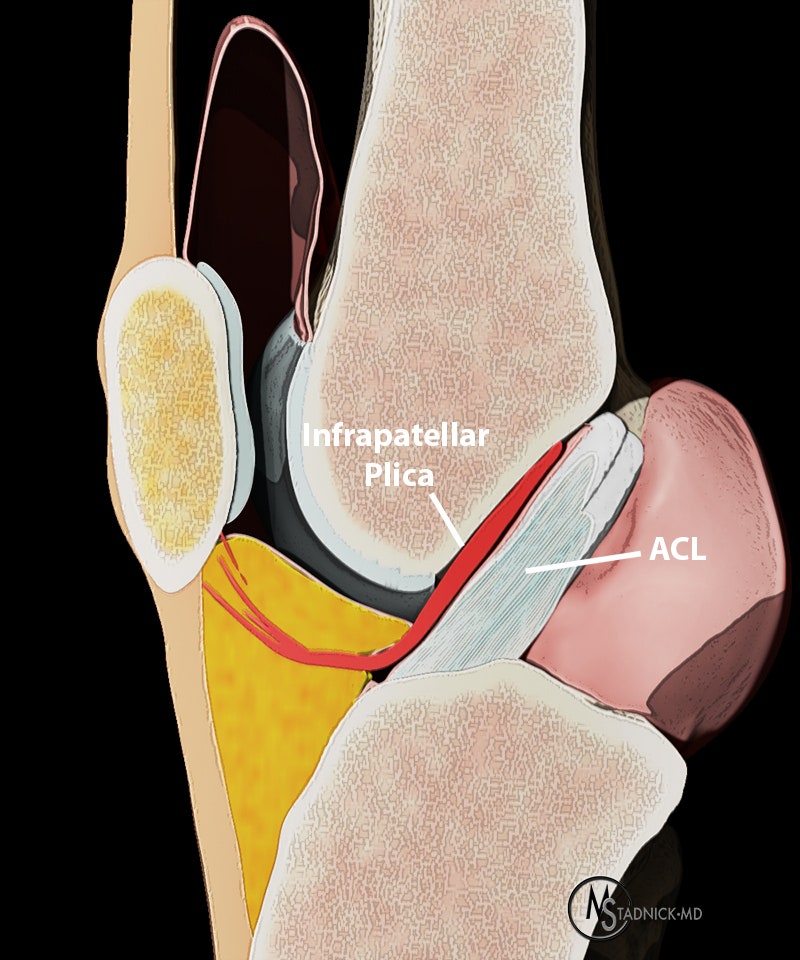 Synovial plica syndrome - 활액막 추벽 증후군 : 네이버 블로그