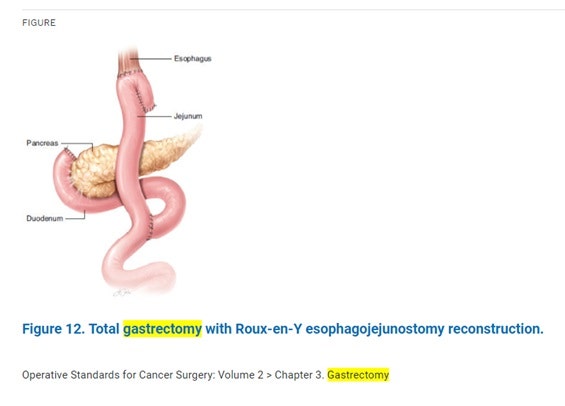 Total Gastrectomy With Roux En Y Esophagojejunostomy