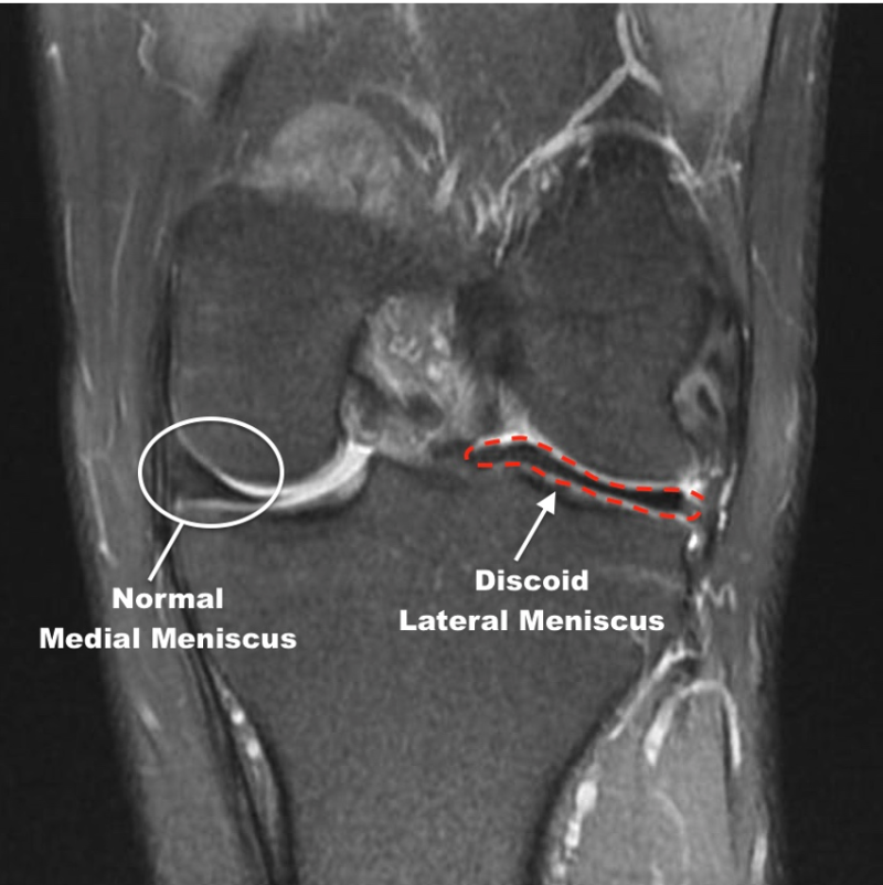 Discoid meniscus – 원판형 반월상 연골 : 네이버 블로그
