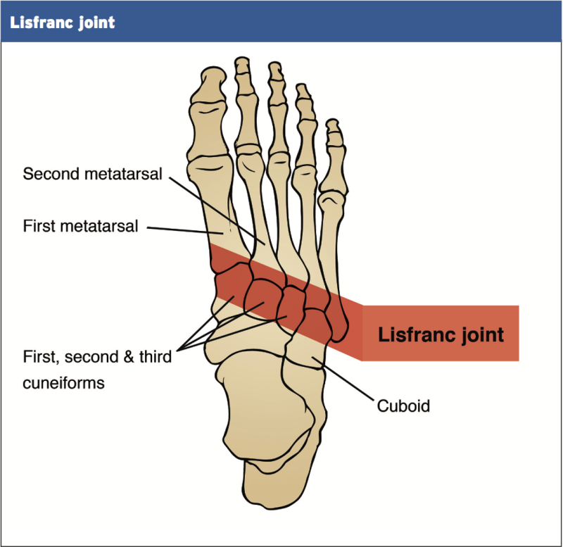 Lisfranc injury – 리스프랑 손상 : 네이버 블로그