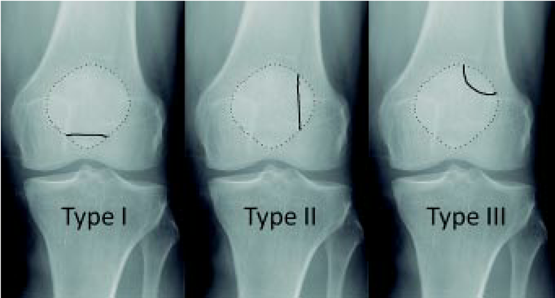 Bipartite patella (이분 슬개골) : 네이버 블로그
