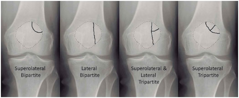 Bipartite patella (이분 슬개골) : 네이버 블로그