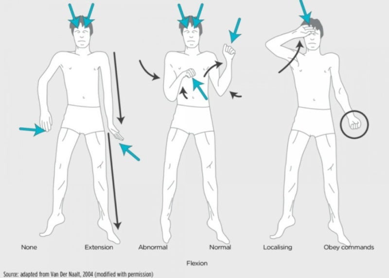GCS(Glasgow coma scale)사정 : 네이버 블로그