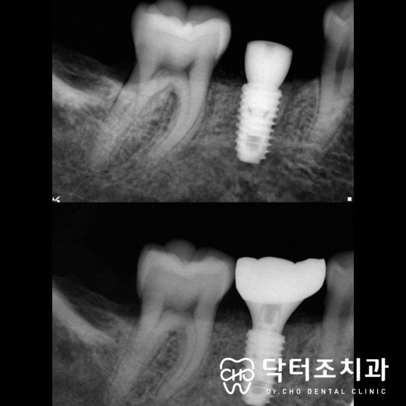 원당 임플란트 치과 임플란트 할 때 꼭 뼈이식해야 하나요 임플란트 뼈이식 치료 방법 네이버 블로그