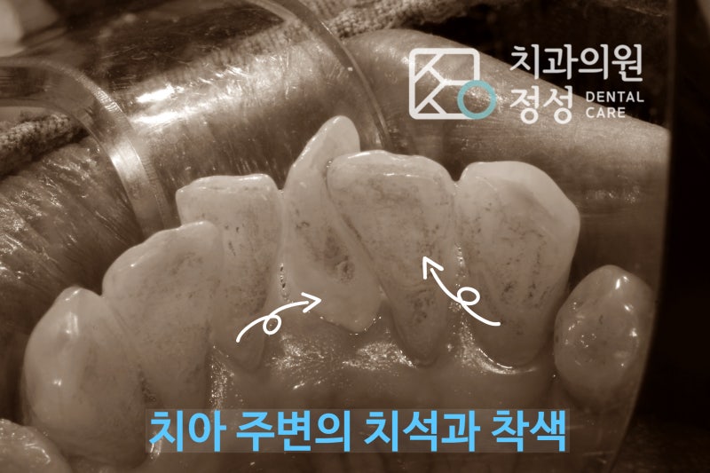 치주염치료 잇몸치료의 종류 네이버 블로그