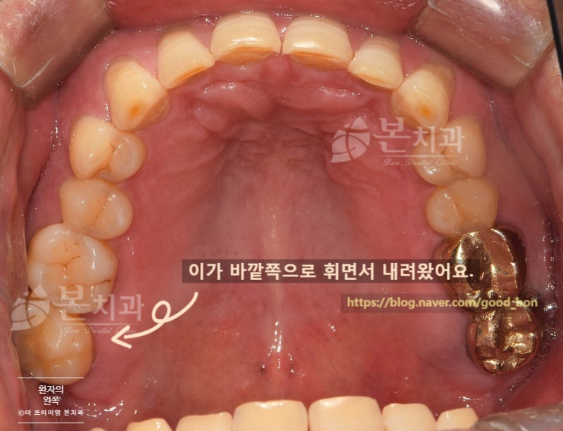 아산본치과의 아산임플란트이야기 이 뽑은 자리로 위에 있는 치아가 내려왔어요 대합치정출이 동반된 임플란트 케이스 네이버 블로그