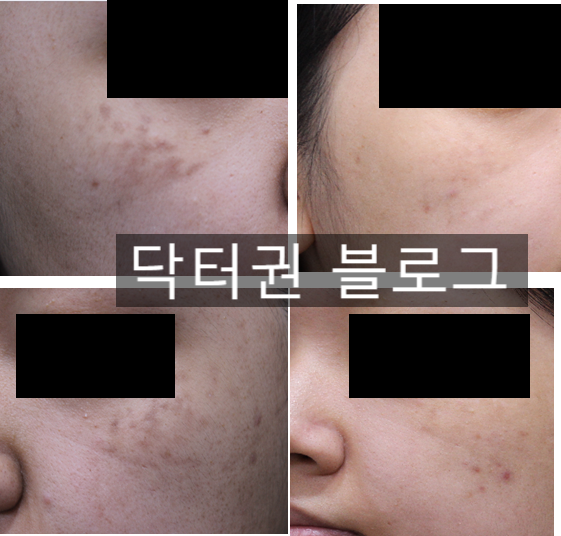 피코레이저 ABNOM (후천성 오타모양반점) 치료 사례 : 네이버 블로그