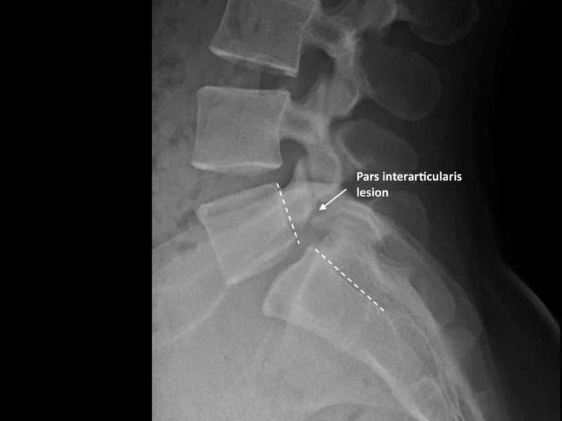 척추분리증(spondylolysis)와 척추전방전위증(spondylolisthesis) : 네이버 블로그