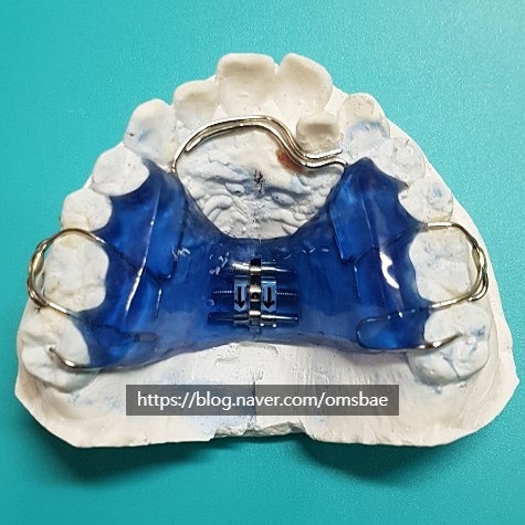 Stage 1 장치와 lateral bite shelves에 대해 : 네이버 블로그