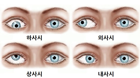 간헐적 외사시 간헐성 외사시 교정 치료 비전테라피시기능훈련 눈운동기구 네이버 블로그