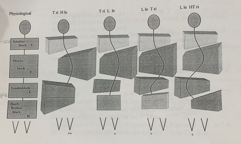 [창원 척추 측만 교정] 척추측만의 분류 - Schroth Classification : 네이버 블로그