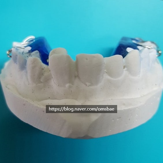 Stage 1 장치와 lateral bite shelves에 대해 : 네이버 블로그