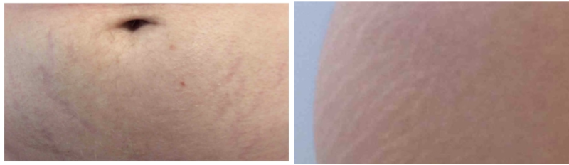 튼살 예방, Striae distensae (stretch marks) : 네이버 블로그