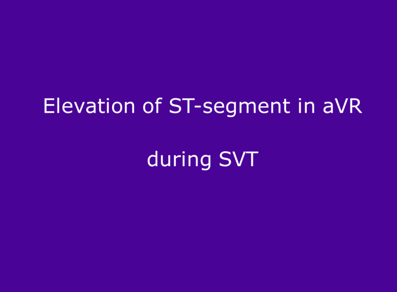 Rated-related aVR ST-segment elevation during SVT [EKG] : 네이버 블로그