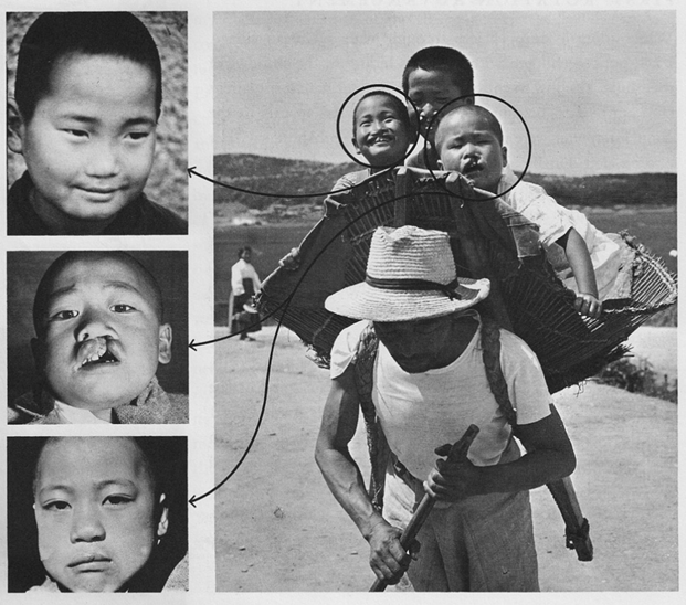 [명의 열전] 랄프 밀라드 (D. Ralph Millard, Jr. M.D., F.A.C.S., 1919-2011) : 네이버 블로그