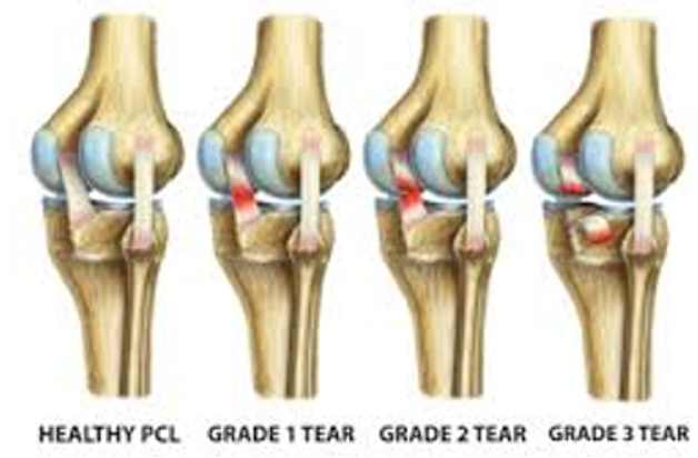 Knee Posterior Cruciate Ligament tear (무릎 후방 십자 인대 파열) : 네이버 블로그