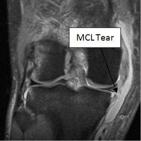 Medial collateral Ligament, MCL injury (내측측부인대 손상) : 네이버 블로그