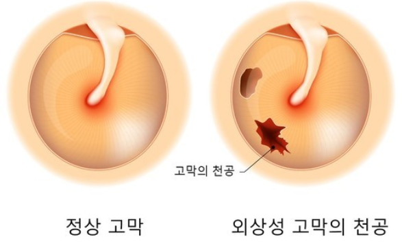 고막 찢어지면 어떻게 될까 고막천공 증상 및 대처방법 네이버 블로그
