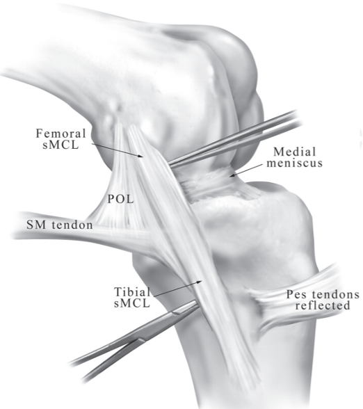 Medial collateral Ligament, MCL injury (내측측부인대 손상) : 네이버 블로그