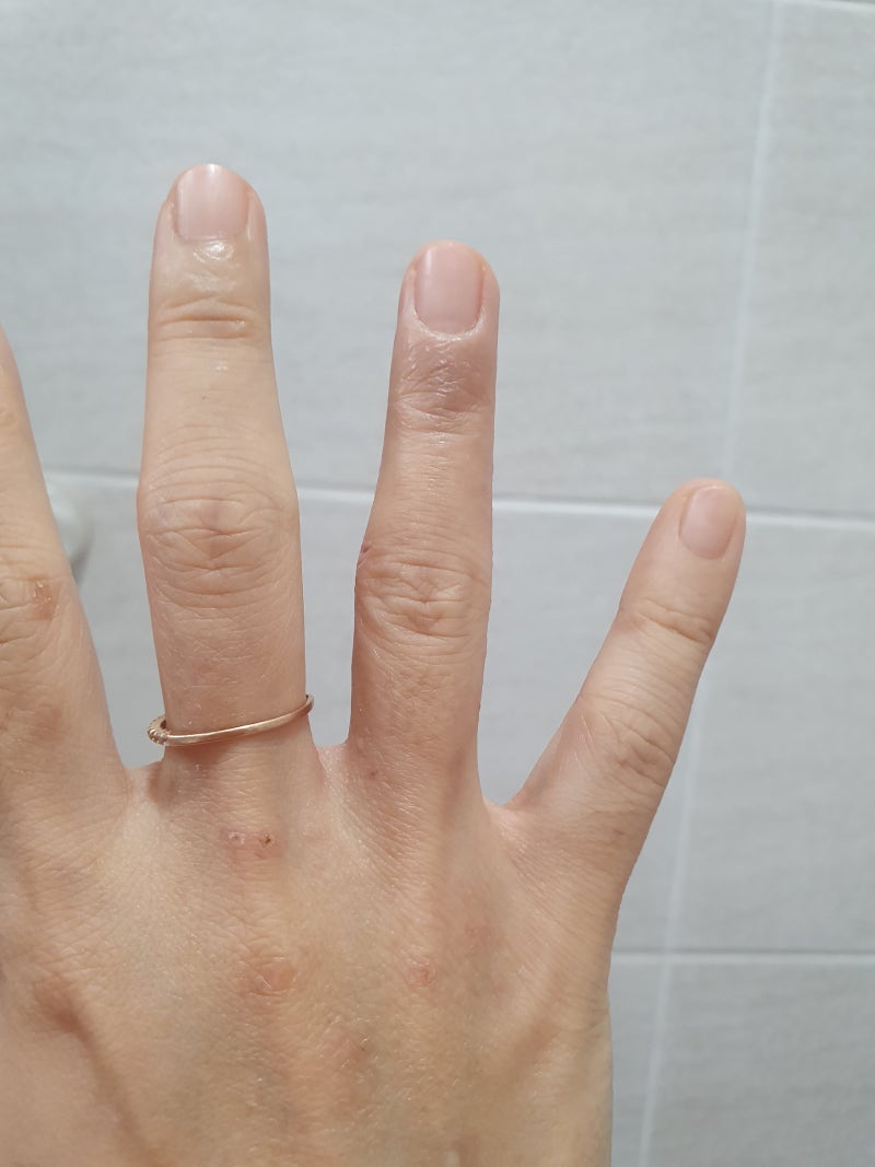 베이드크림 20g 피부질환치료제 성인 얼굴아토피 치료 스테로이드 연고예요 네이버 블로그