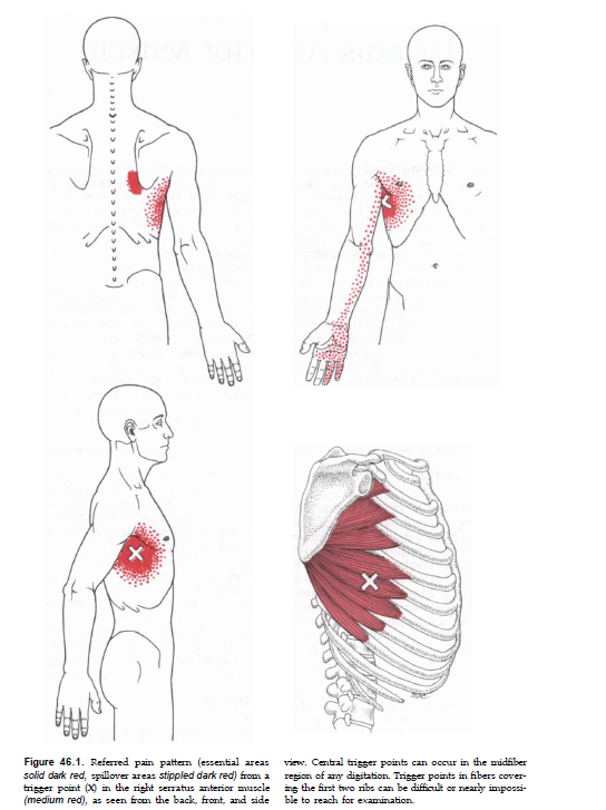 전거근 통증 유발점 (Serratus anterior Trigger point) : 네이버 블로그