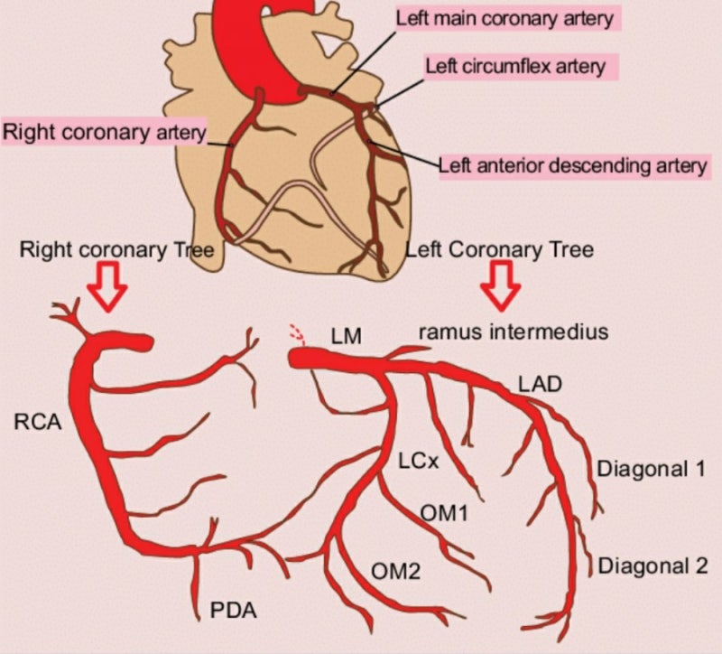 PTCA, PCI, 경피적관상동맥성형술, 경피적관상동맥스텐트삽입술 간호, PTCA 간호 : 네이버 블로그