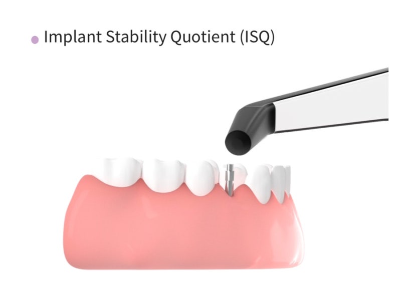 Implant 골유착(osseointegration) 정도를 알 수 있는 최신 ISQ 측정장비 Osstell Beacon ...