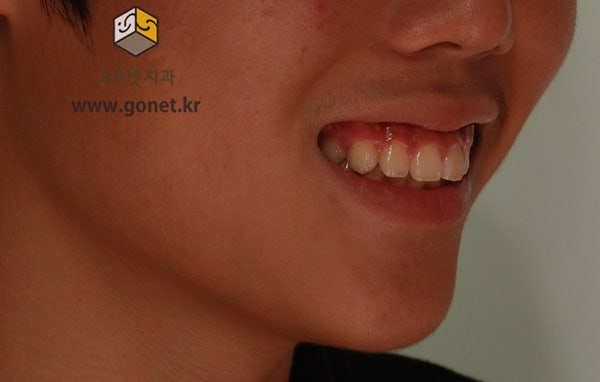 수술 없는 잇몸뼈 돌출의 치료 네이버 블로그