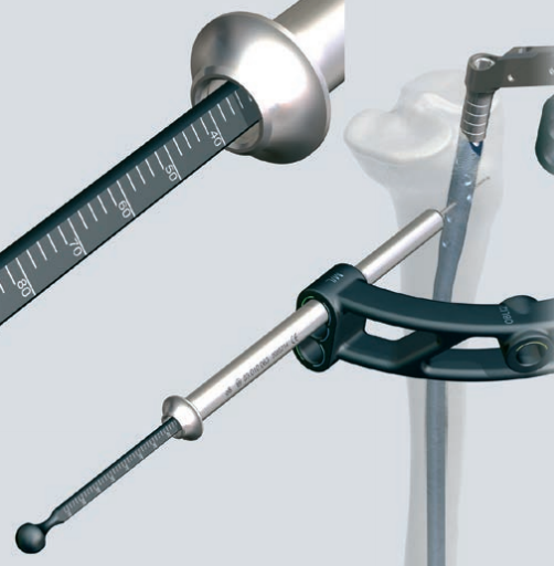CRIF IM nail tibia - Dr.D : 네이버 블로그